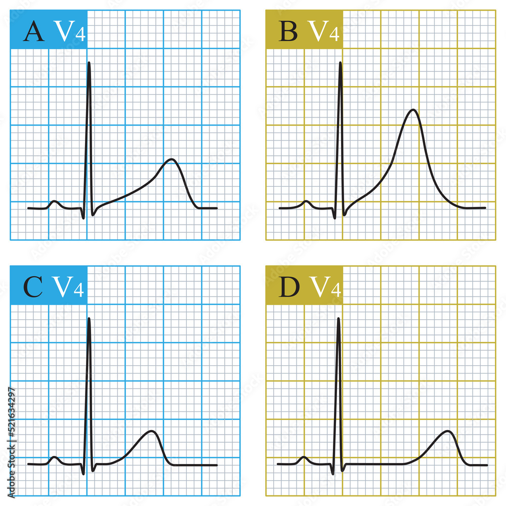 A is infantile type, short ST segment, fast fusion with T wave; B is a ...