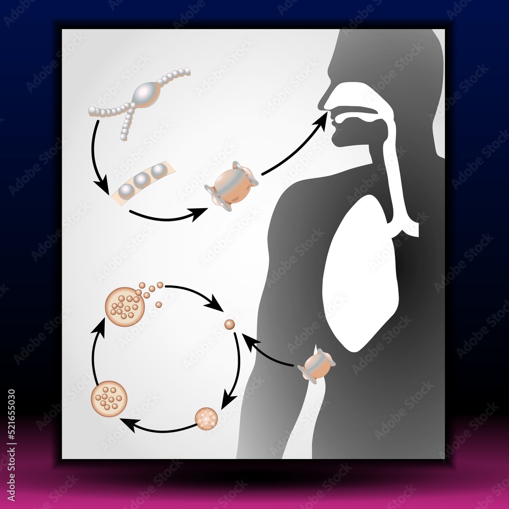 LUNG Coccidioidomycosis - Fla source file available - The coccidioides ...