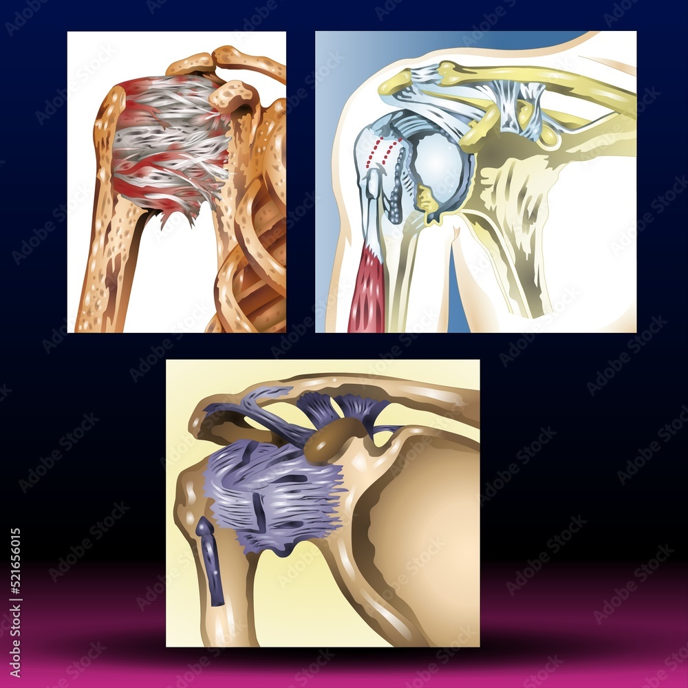 Frozen Shoulder - Fla source file available - Frozen shoulder occurs ...