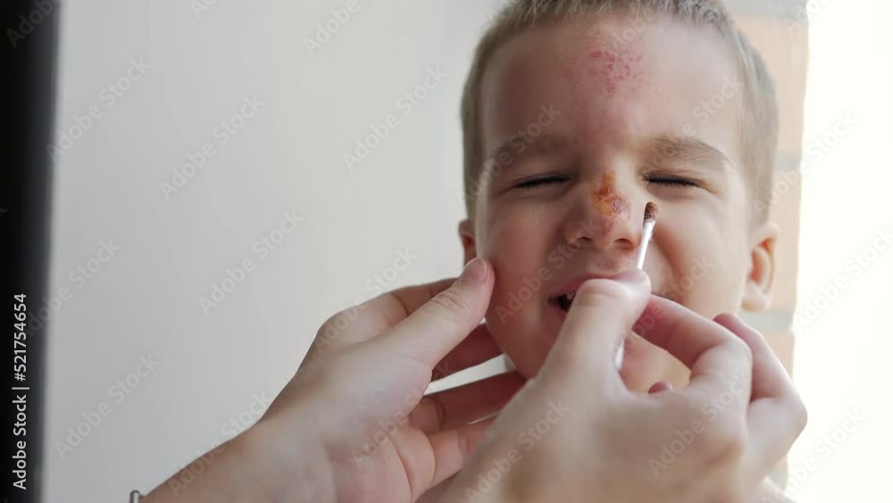 A caring mother applying antiseptic cream to a scratch and a bump on ...