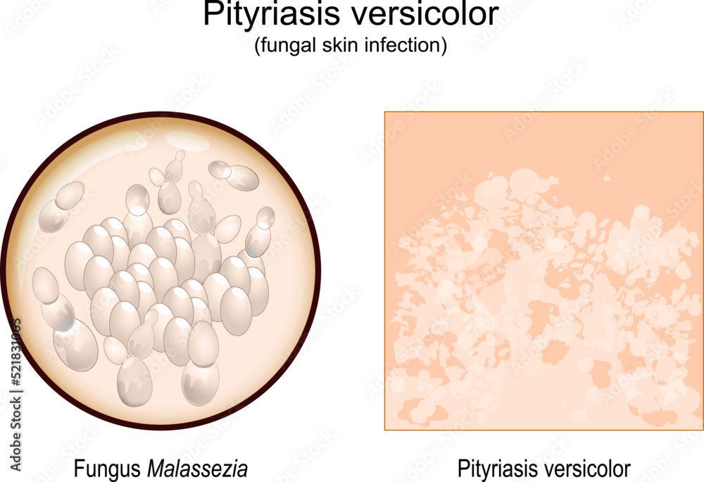 pityriasis versicolor. skin surface. Malassezia fungi Stock Vector ...