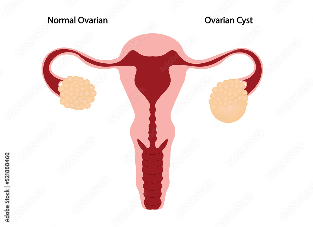 Ovarian Cyst Anatomy Illustration Uterus With A Cyst In The Left Ovarian Stock Vector Adobe Stock