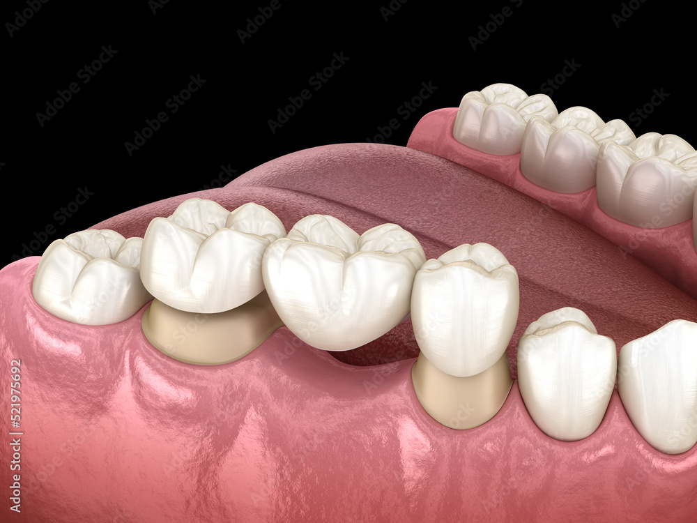 Molar and premolar tooth and dental bridge placement. Medically ...