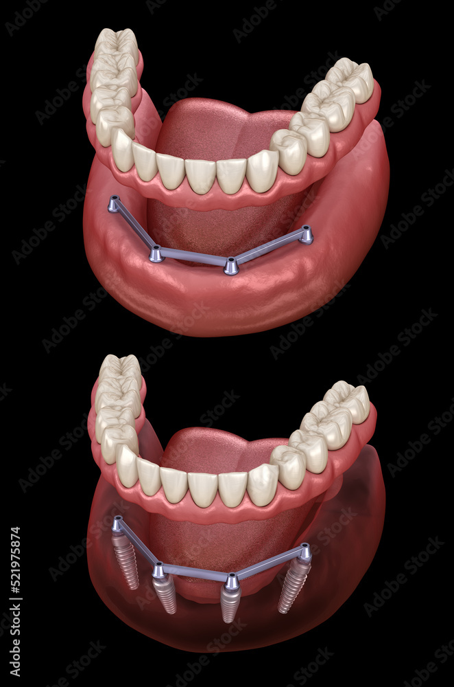 Mandibular prosthesis with gum All on 4 system supported by implants ...