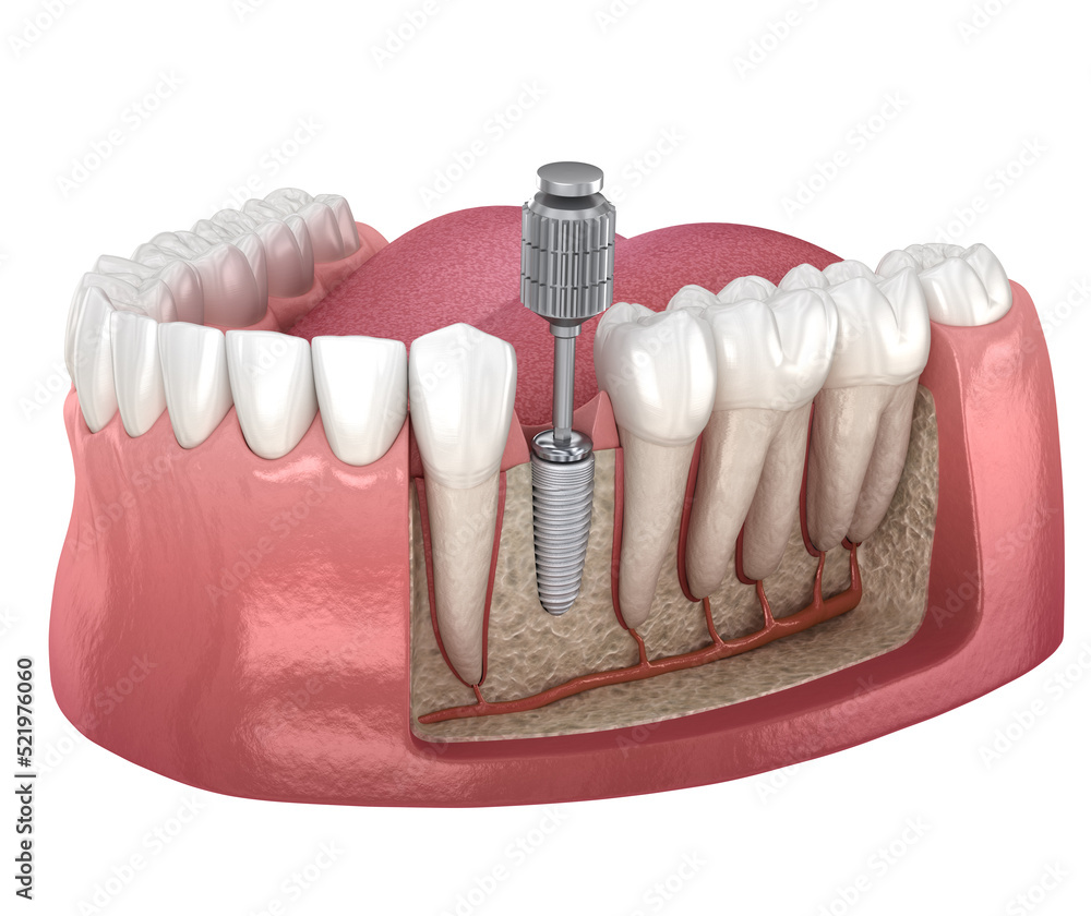 Implant screwdriver makes cover screw fixation procedure. Medically ...