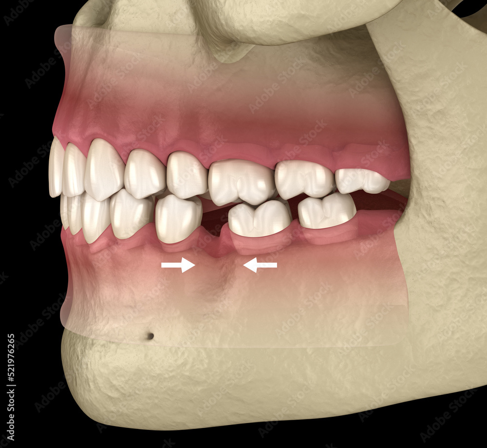 Teeth shift deformatiuon after losing molar tooth. 3D illustration of ...