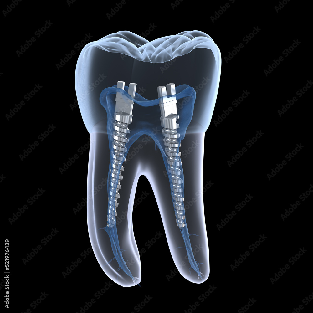 Dental steel post inside molar teeth, Xray view. Dental endodontic ...