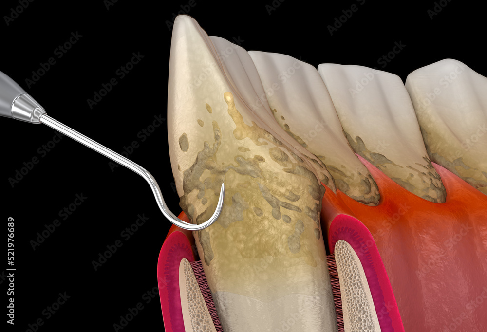 Oral hygiene: Scaling and root planing (conventional periodontal ...