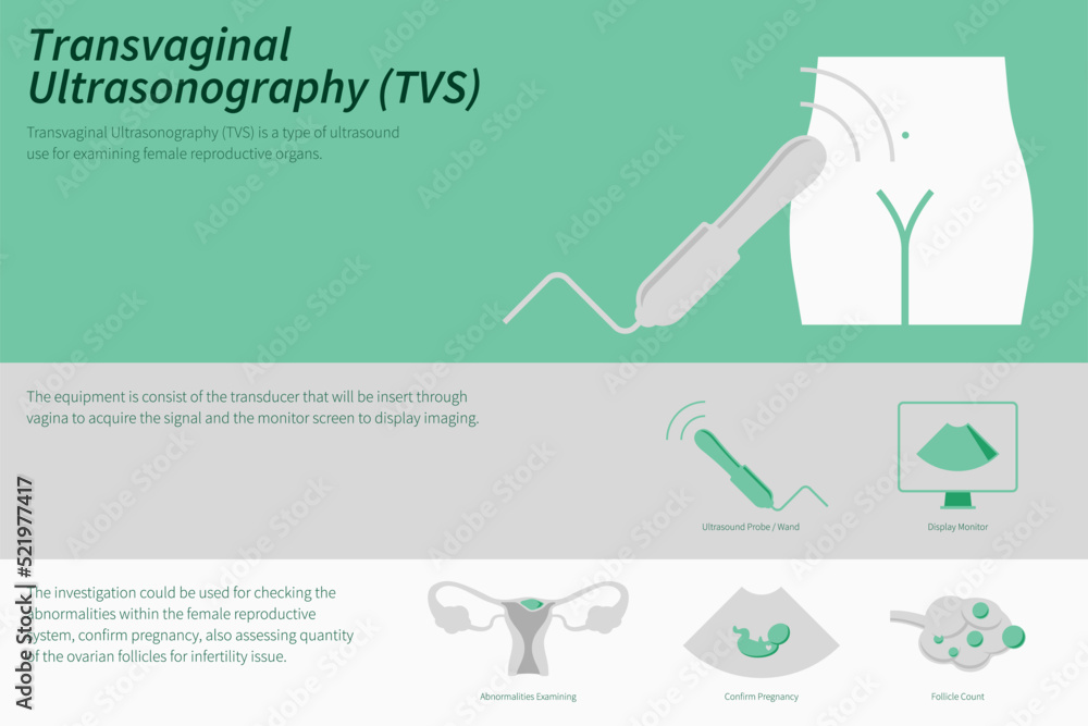 Transvaginal Ultrasonography TVS horizontal infographic illustration ...