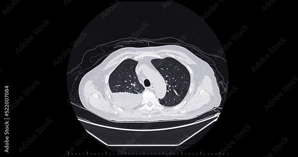 CT Chest or CT Scan of Lung for diagnosis TB,tuberculosis and ...