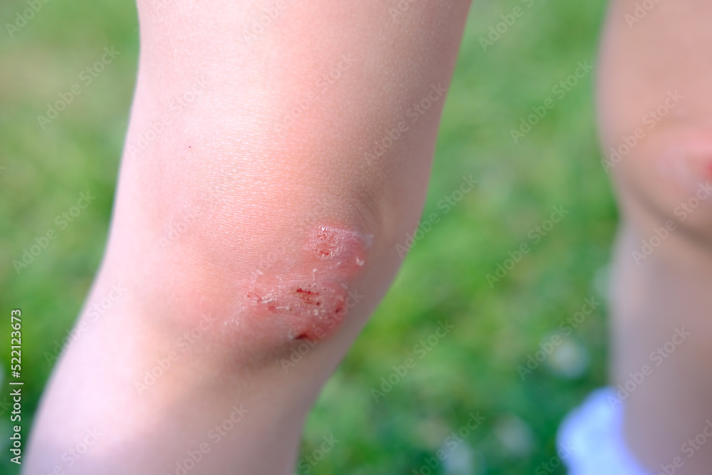 fresh wound, bleeding abrasion on knees of girl child fell on walk ...