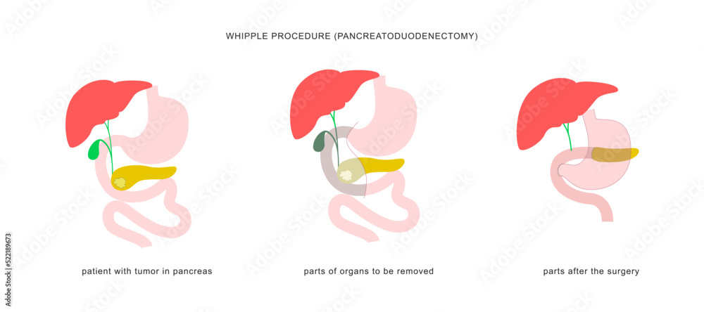 Medical infographic of whipple procedure pancreaticoduodenectomy ...