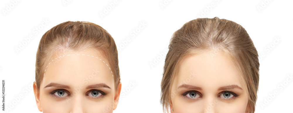 Thinning hair and hair loss,female pattern baldness,Hair transplant ...