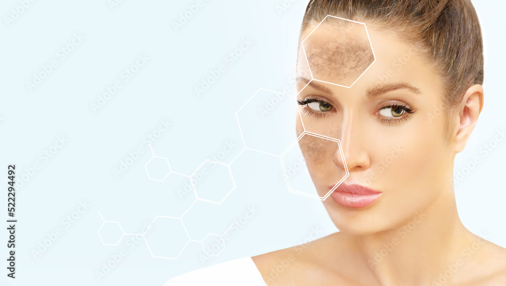 Hyperpigmentation: chloasma, melasma , age spots,Post-inflammatory ...