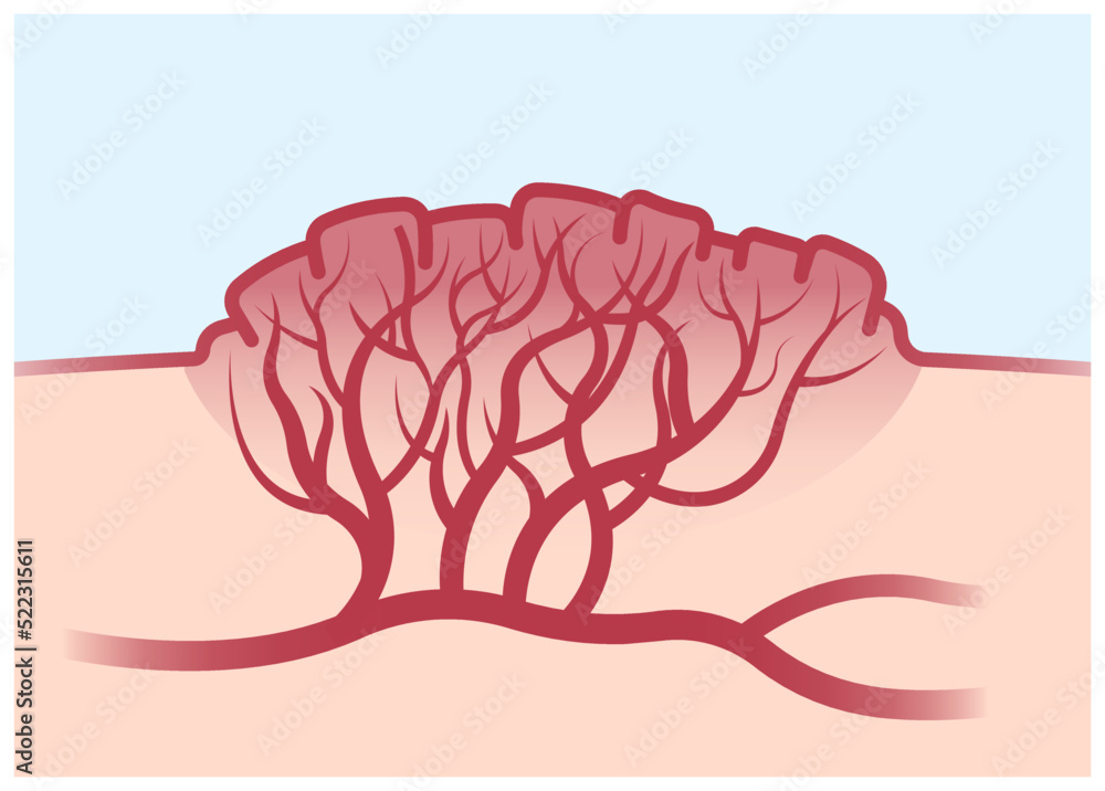 Poster vascular tumor or venous malformations of Hemangioma on Facial ...