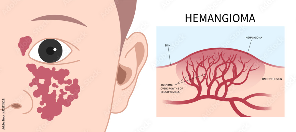 Non cancerous Hemangioma on Facial child tumor disorder disease Stock ...