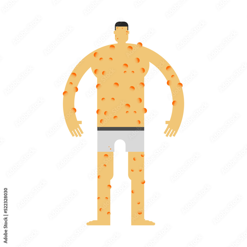the skin rash lesion of monkeypox virus infection. Stock Vector | Adobe ...