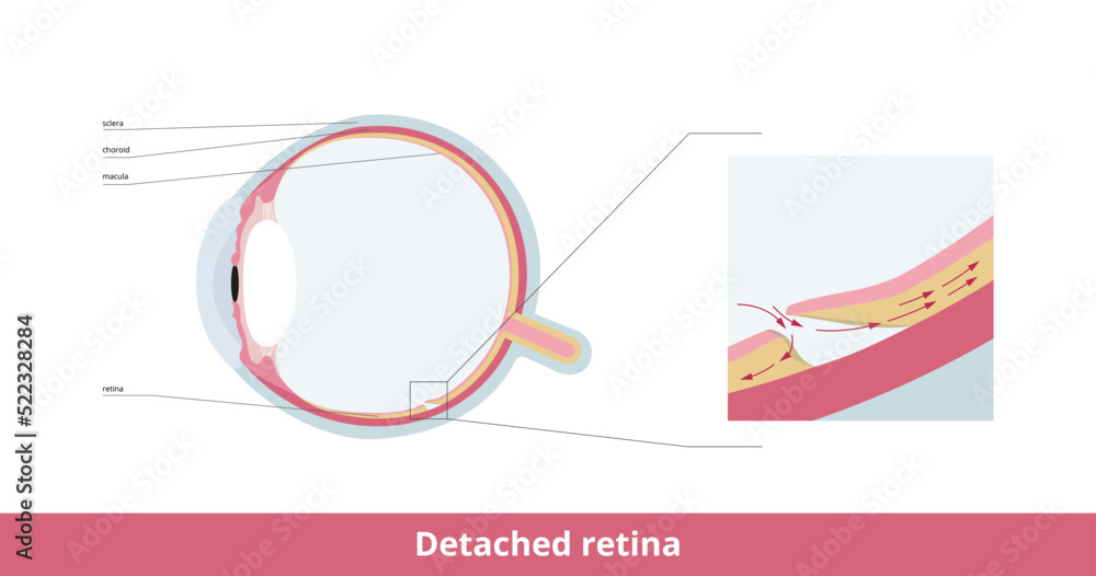 Detached retina (retinal detachment). The thin layer at the back of the ...