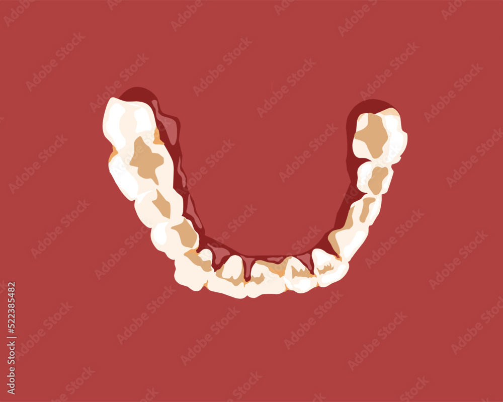 Gingivitis. Inflammation of the gums. Dental calculus. Infographics ...