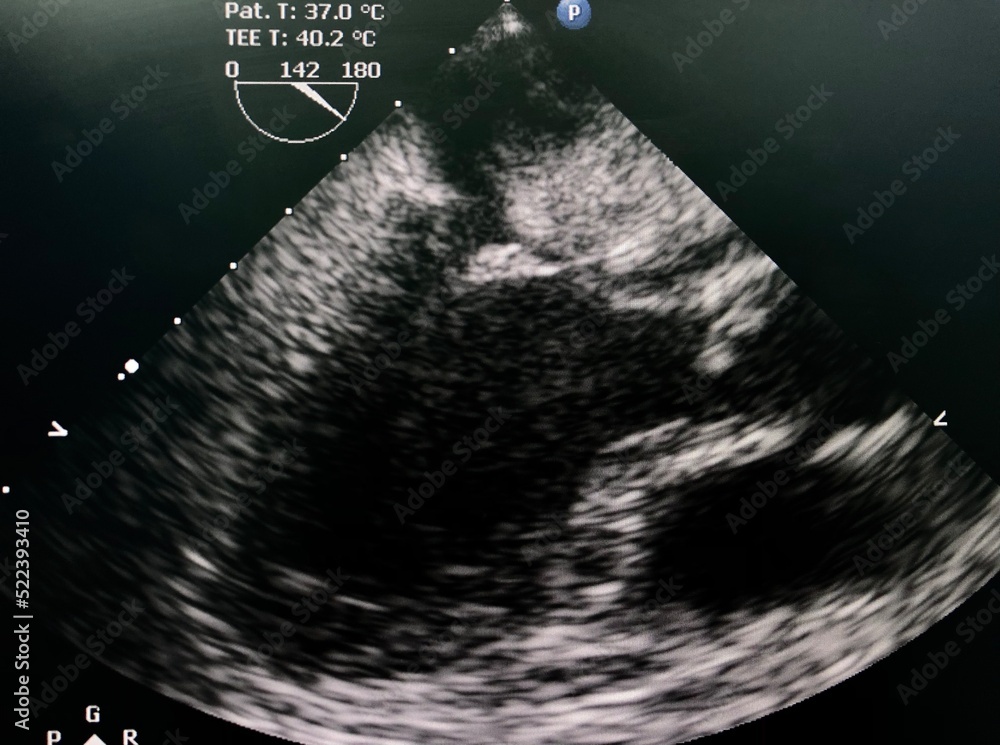 Transesophageal echocardiogram (TEE) shown left atrial (LA) myxoma ...