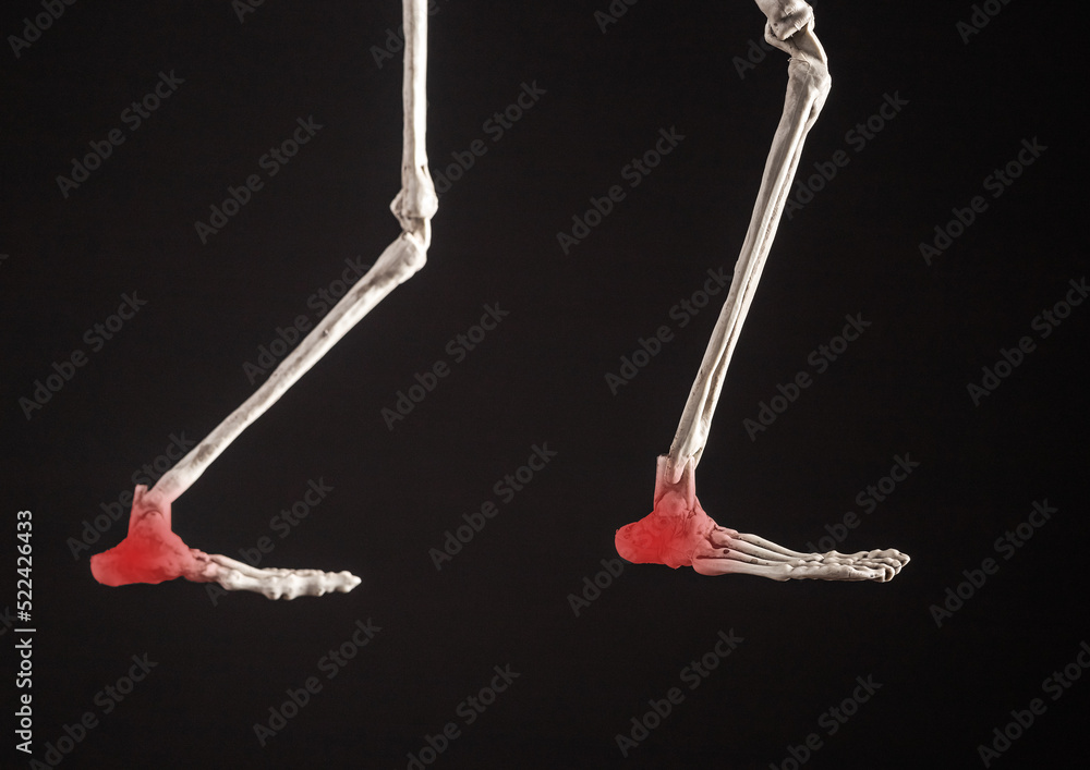 Human skeleton legs with painful heel with red spot on black background ...