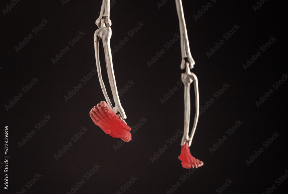 Human skeleton legs with painful feet with red point on black ...