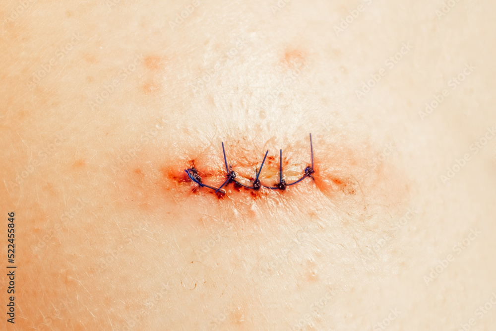 Medical sutures after operations, sewn surgical sutures on the human ...
