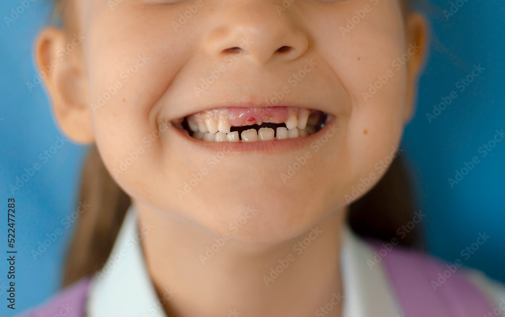 Portrait of girl with missing teeth. A baby's mouth of baby without ...