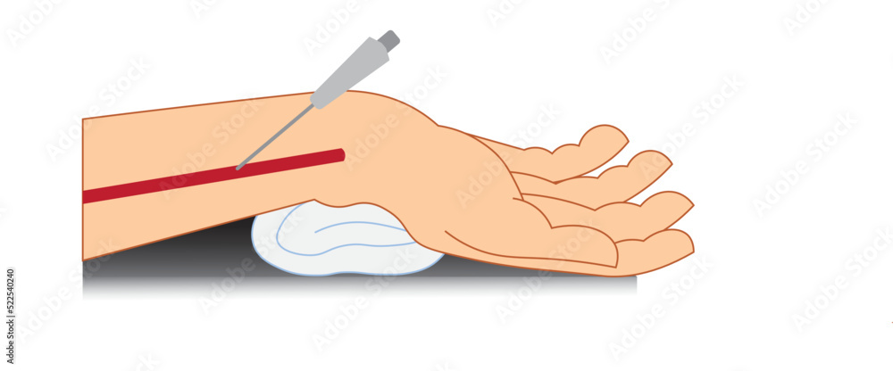 Radial artery puncture illustration. Showing correct catheter position ...