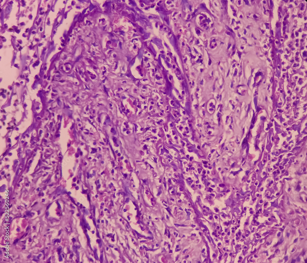Microscopic tissue of retromolar region, show buccal mucosa, squamous ...