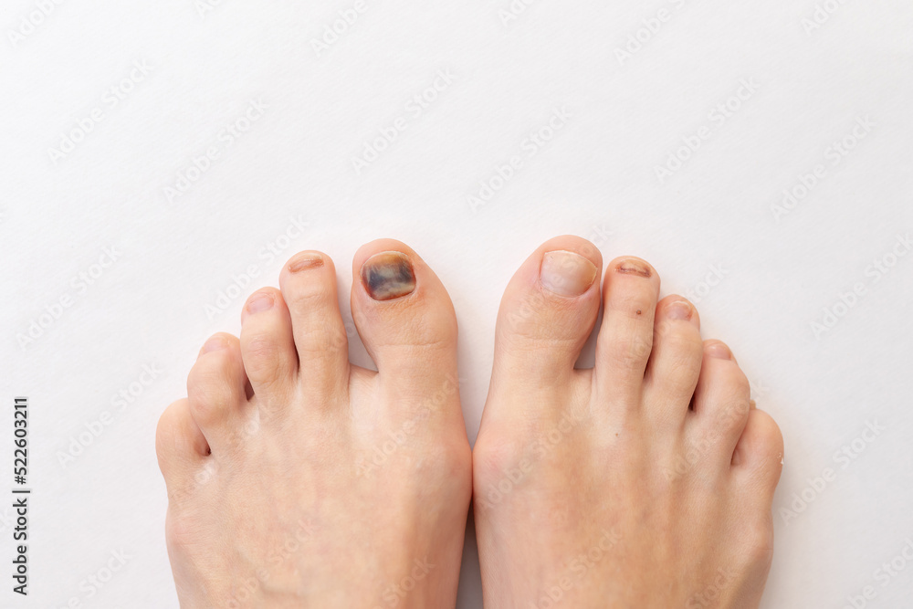 Subungual hematoma present under the toenail of the hallux, more ...