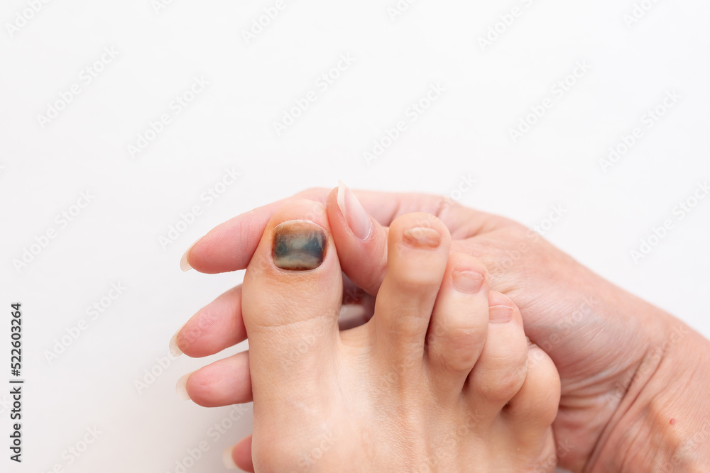 Subungual hematoma present under the toenail of the hallux, more ...