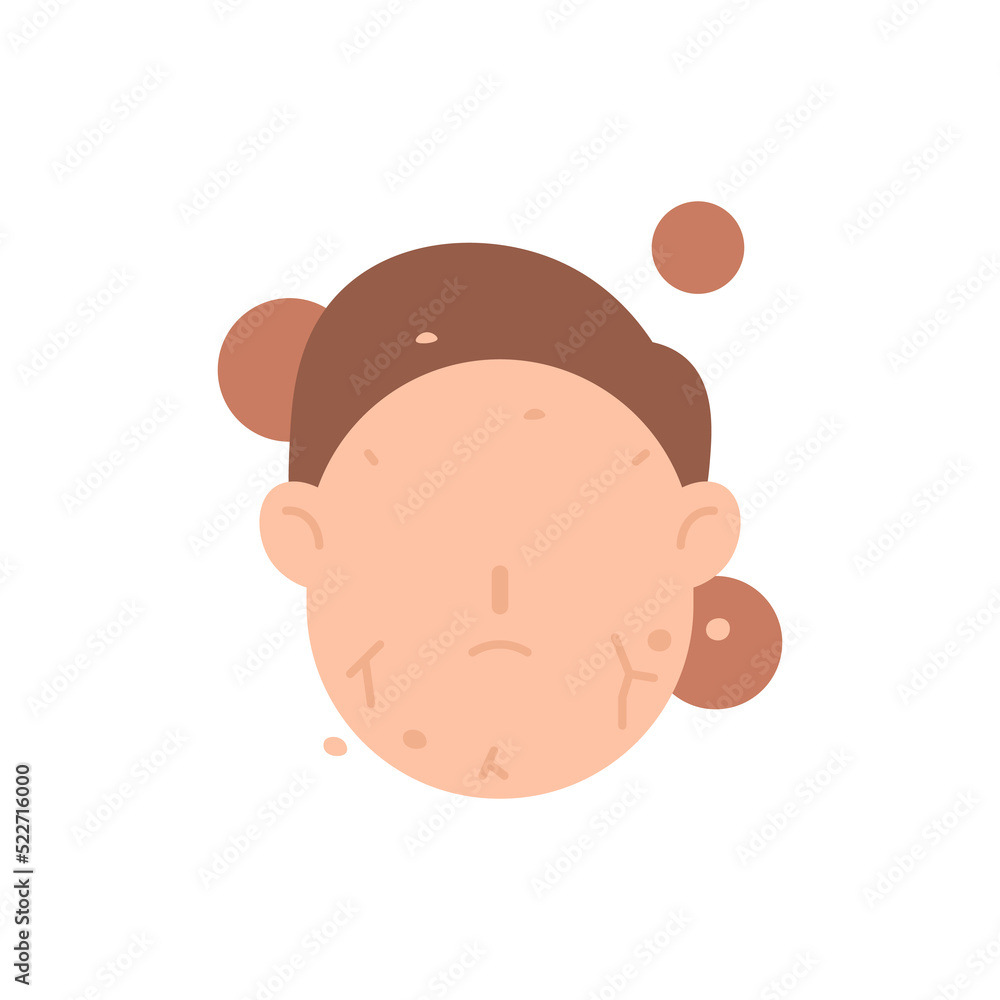 Xerosis, a dry and peeling skin condition. the skin on the face is ...