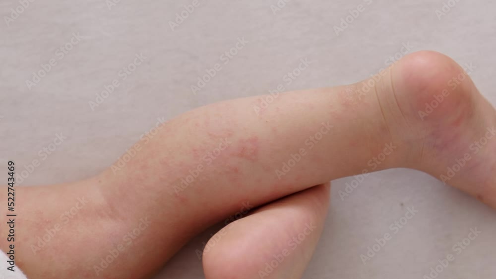 atopic eczema dermatitis sleeping baby legs, red irritation allergic ...