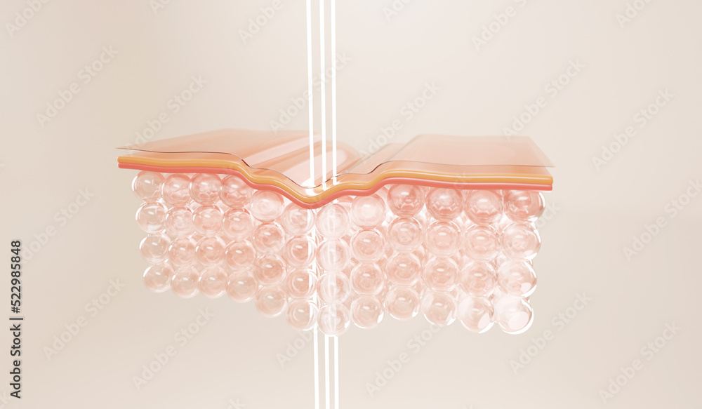 laser or serum vitamin through the skin layer for repair wrinkles and ...