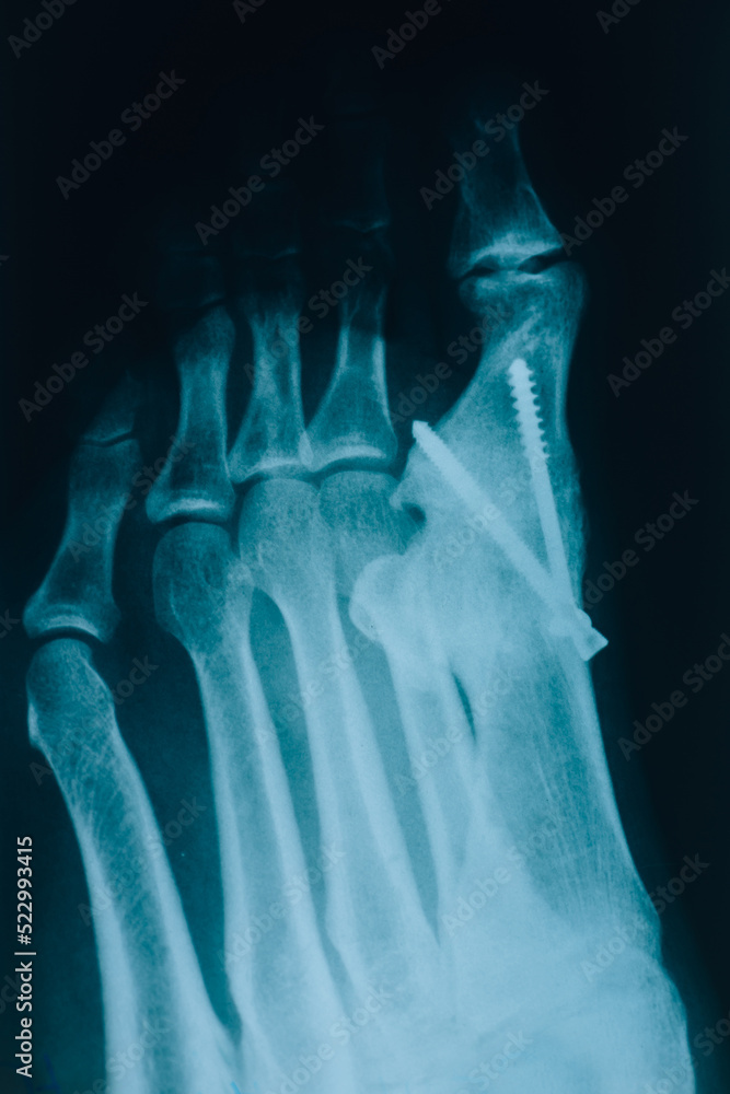X-ray of the toes. Foot injury. Shot of leg with fixation pins Stock ...