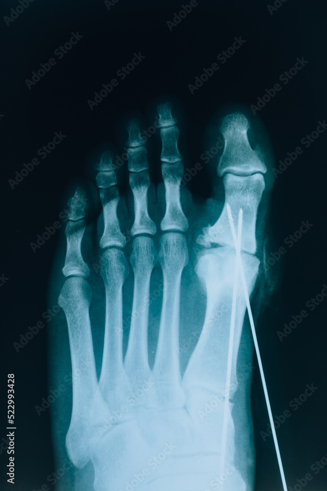 X-ray of the toes. Leg injury. Shot of the foot with pins Stock Photo ...