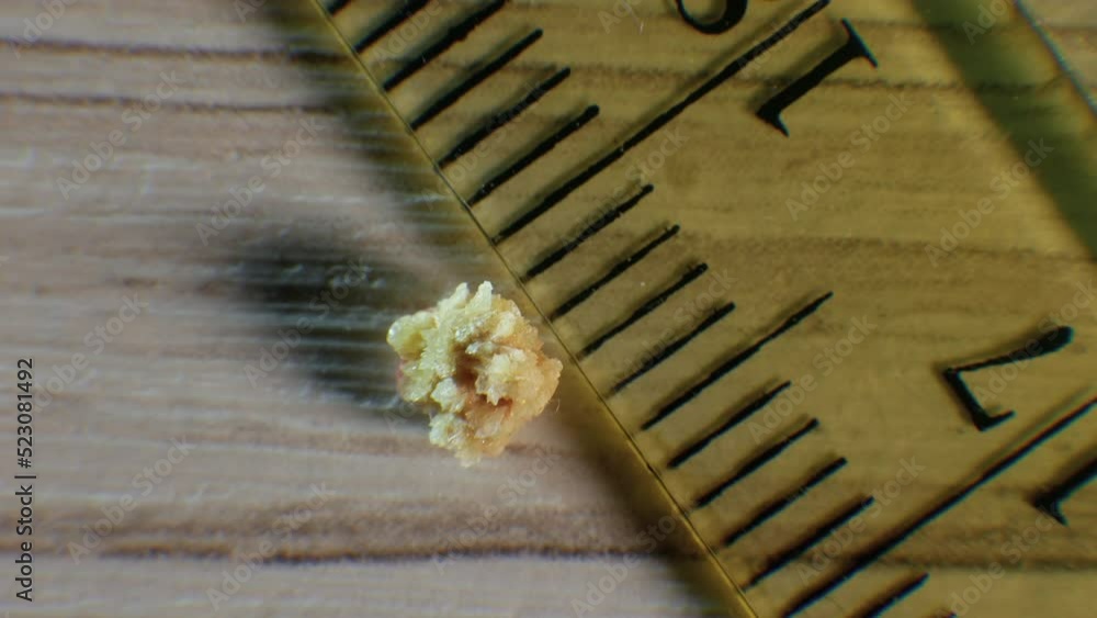 Oxalate kidney stone 4 mm, the stone was removed from the kidney, close ...