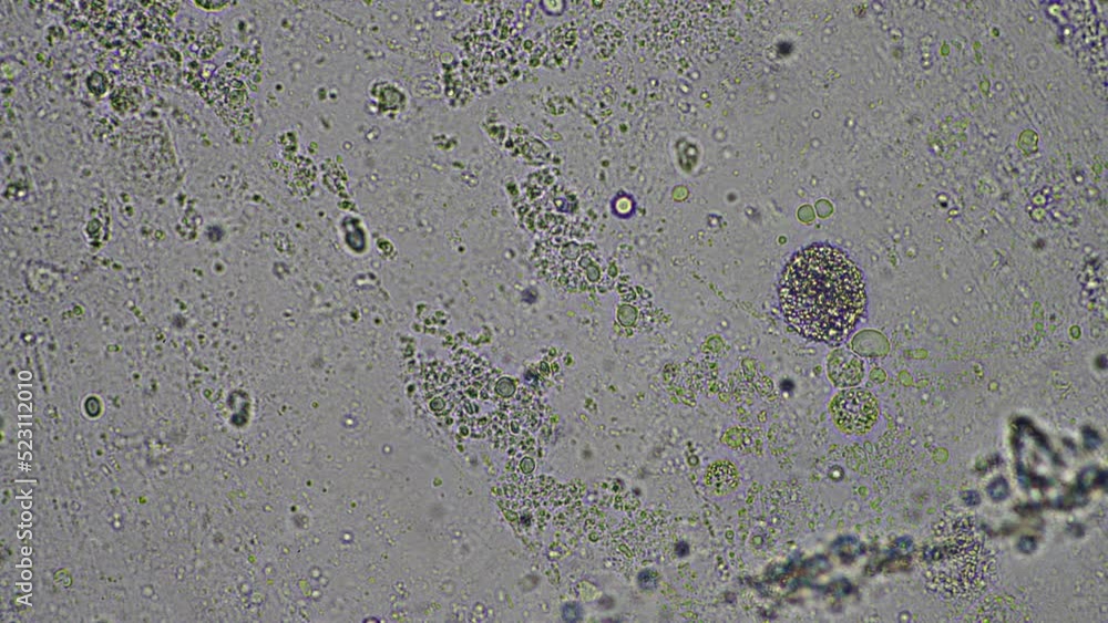 Coughing up mucus and phlegm from a chest infection from a virus and ...