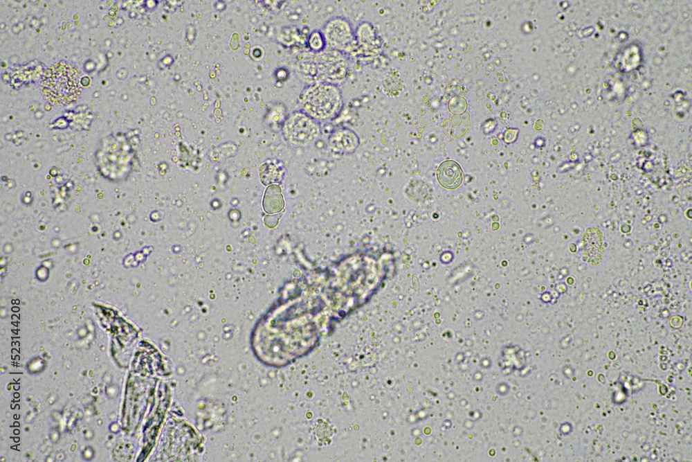 person with a virus coughing, Phlegm and mucus under the microscope ...