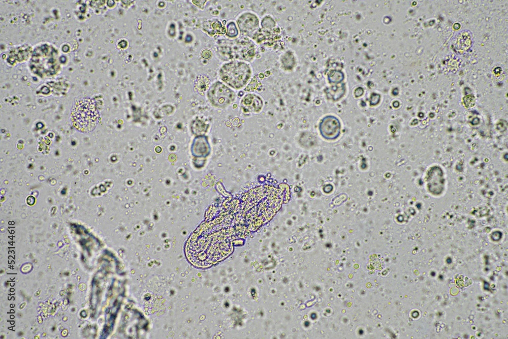 Coughing up mucus and phlegm from a chest infection from a virus and ...