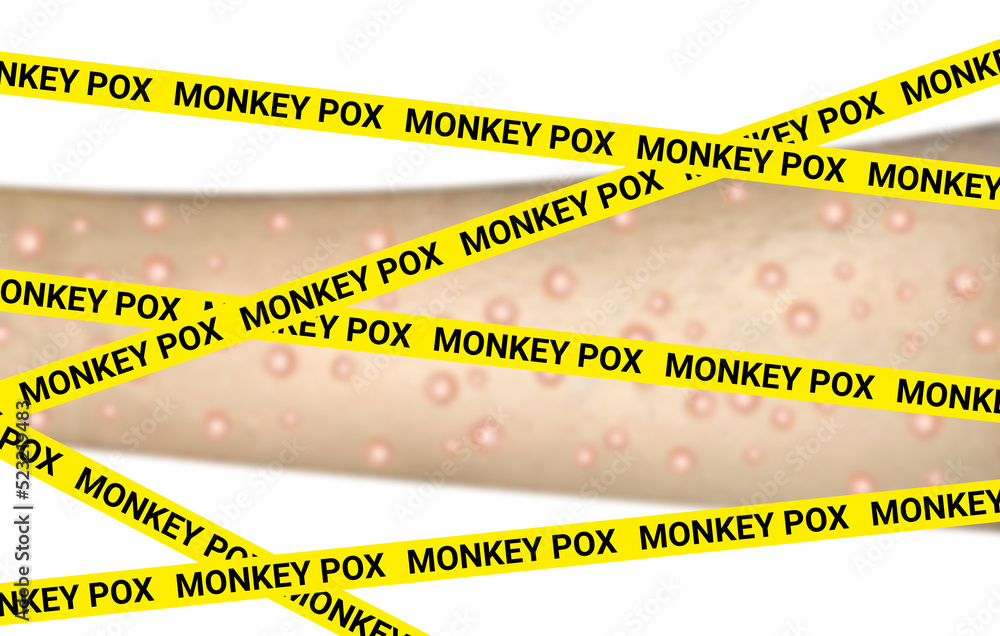 monkey pox yellow crime spot line on blur pox virus in human body ...