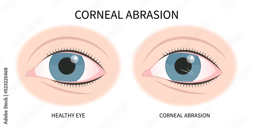 eye lens injury pink red surfer's blurry ulcer bacteria vision loss ...
