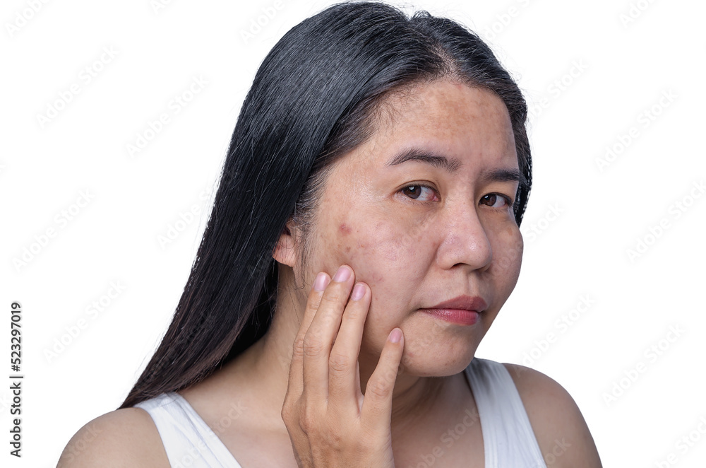 Asian adult woman face has freckles, large pores, blackhead pimple and ...