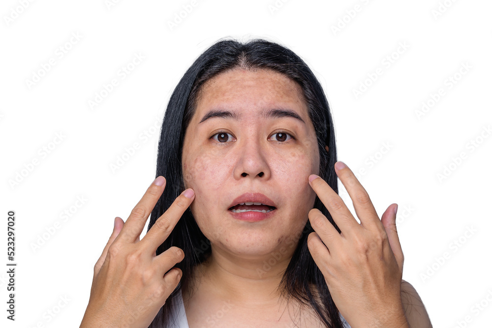 Asian adult woman face has freckles, large pores, blackhead pimple and ...