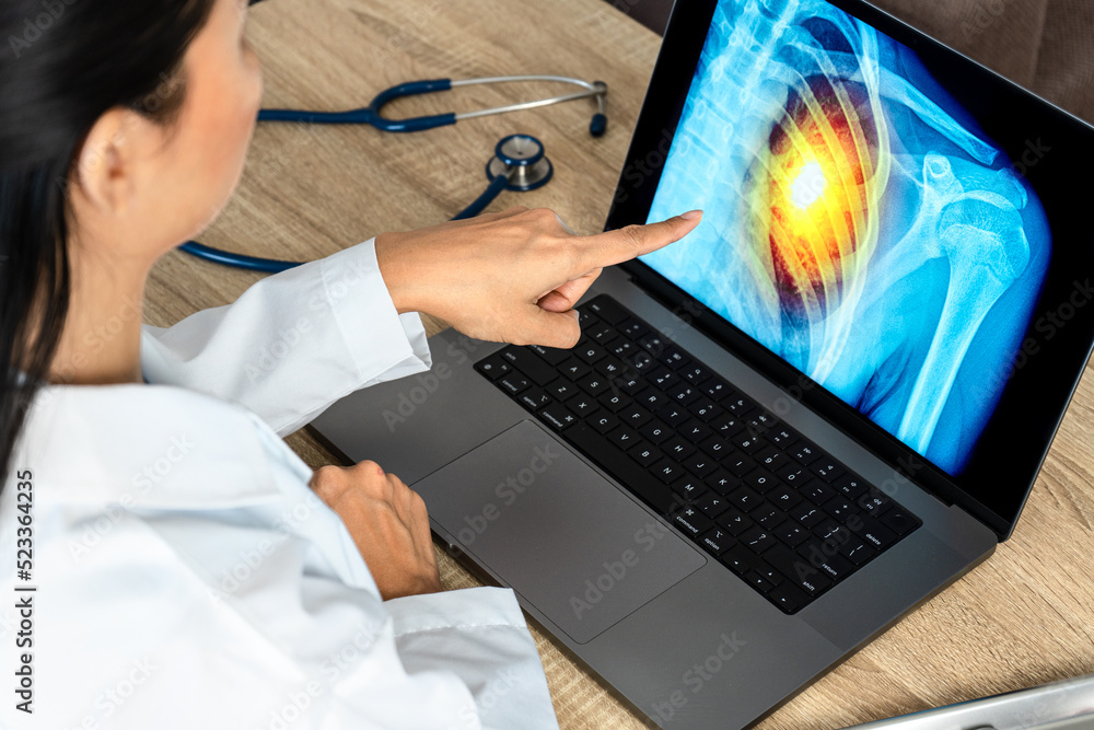 Doctor showing a x-ray of pain in the ribs. Heart attack or chest ...