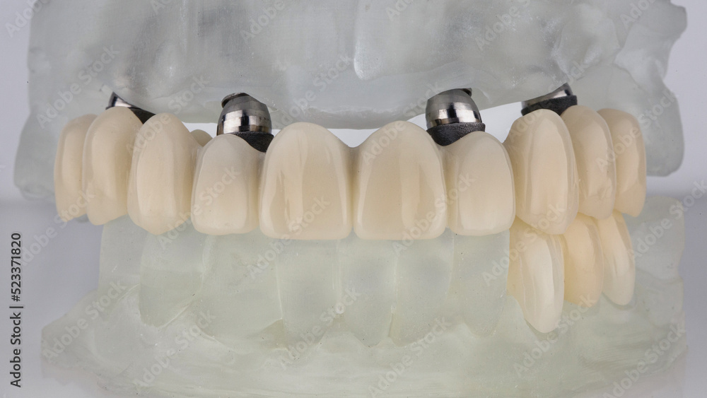 temporary dental prosthesis of the upper jaw on the beam and three ...