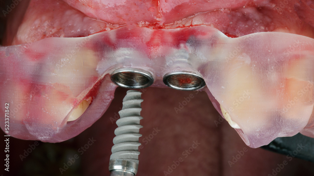 the moment of insertion of the dental implant through the template in ...