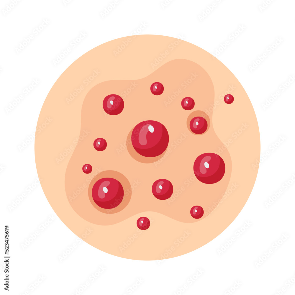 Educational banner. Allergy rash symptom cartoon vector illustration ...