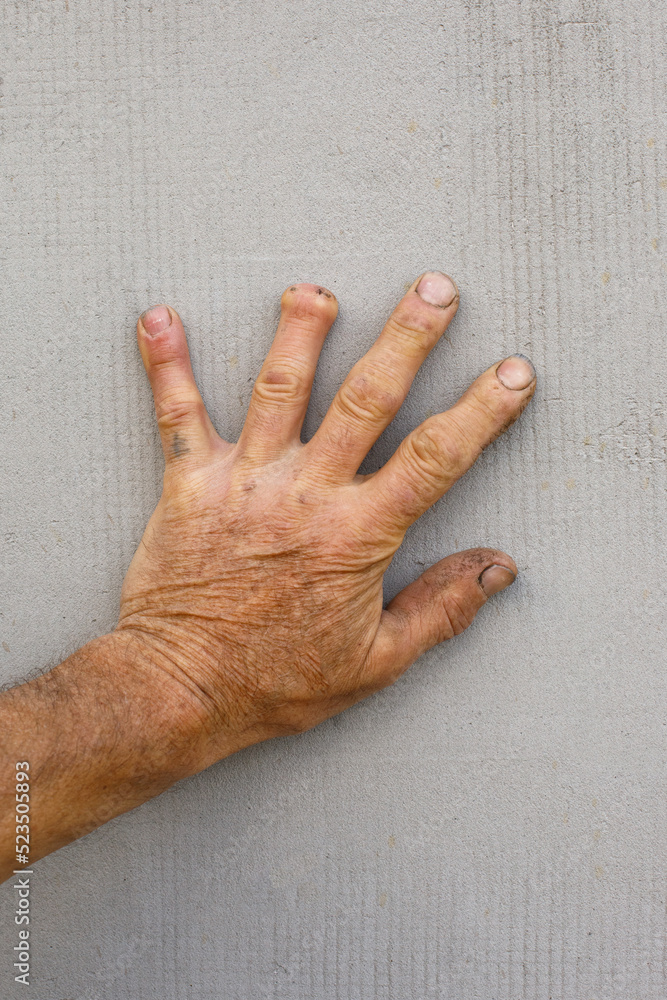 Male turner with professional injury - amputation of part of the finger ...
